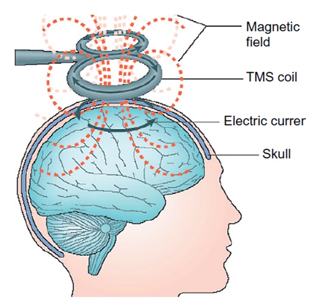 تی ام اس چیست و rTMS چگونه درمان می کند ؟ – کلینیک ذهن برتر ایرانیان